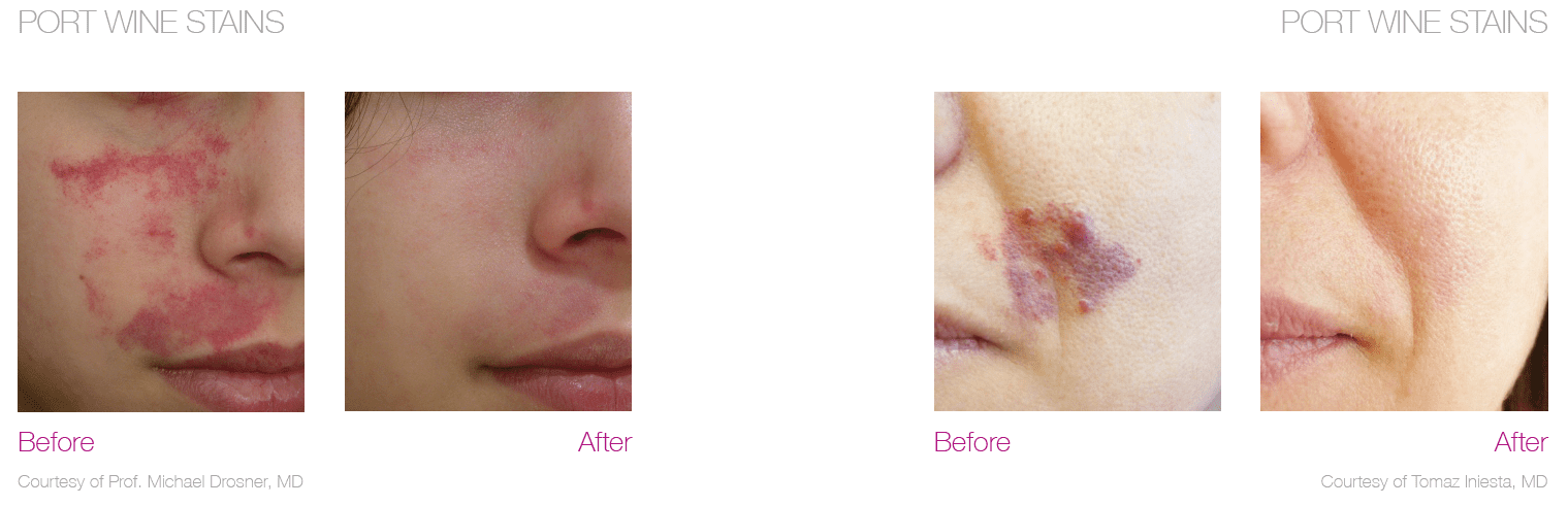 Laser Treatment - Millennium Physicians Laser Treatment - Millennium Physicians