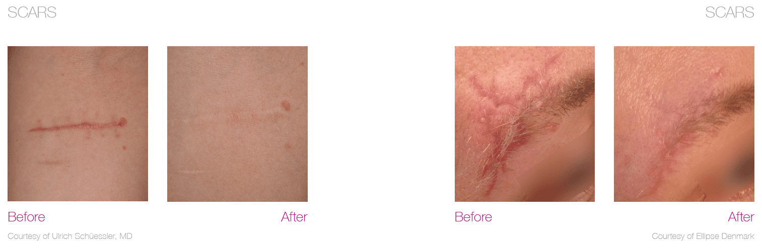 Laser Treatment - Millennium Physicians Laser Treatment - Millennium Physicians